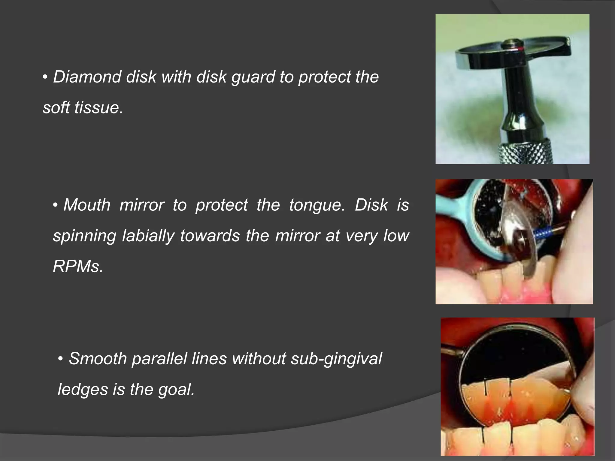 Interproximal Enamel Reduction (stripping) | PPTX