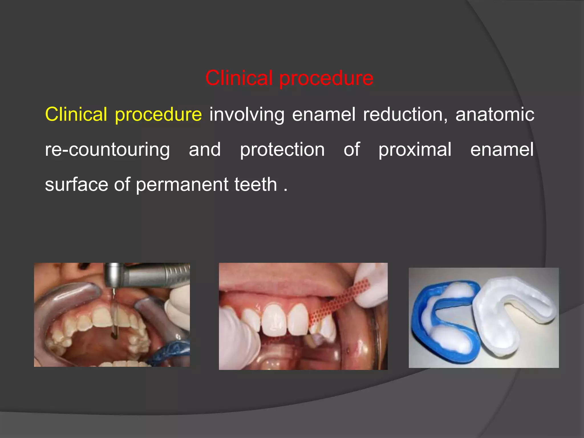 Interproximal Enamel Reduction (stripping) | PPTX