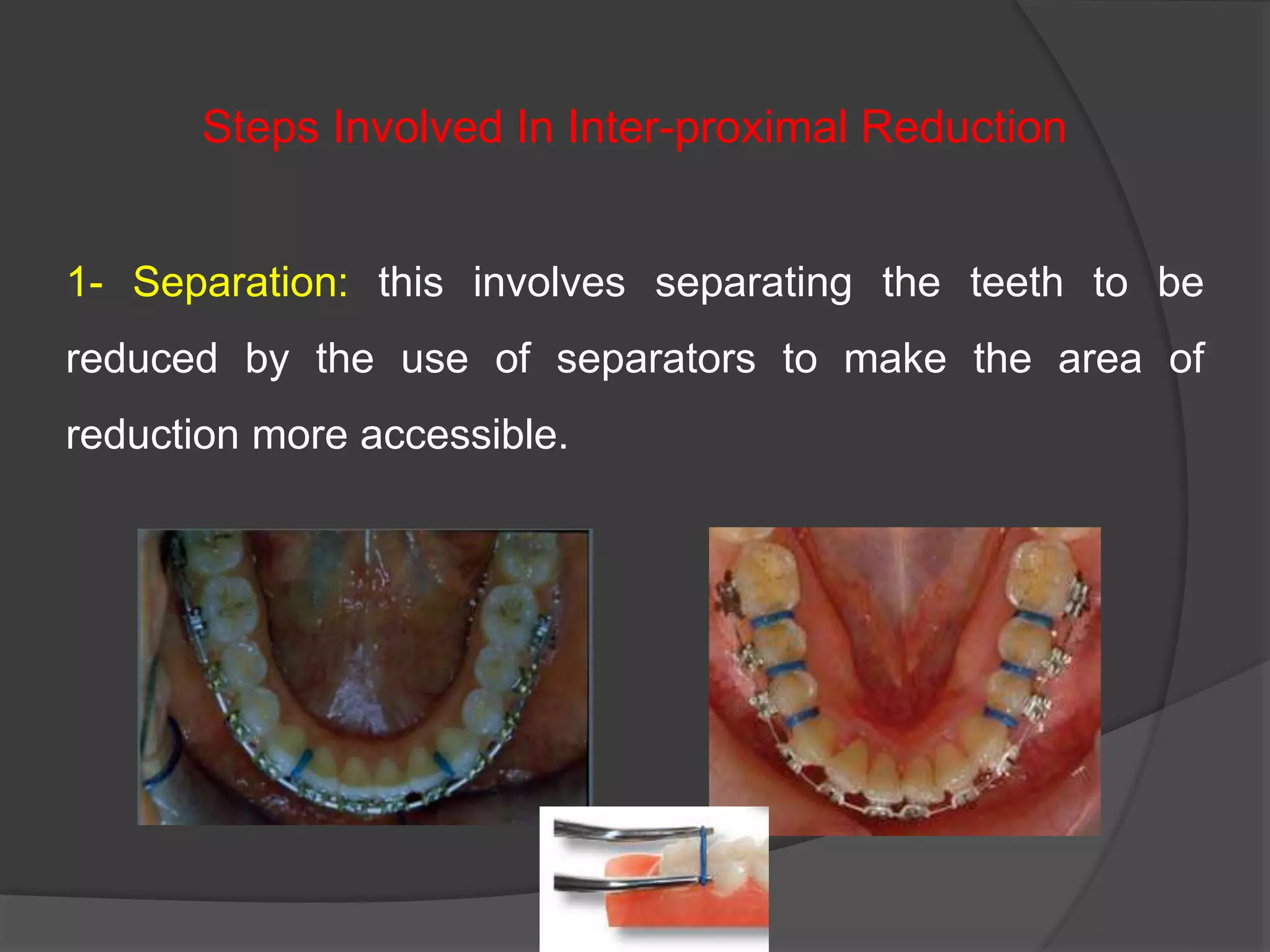 Interproximal Enamel Reduction (stripping) | PPTX