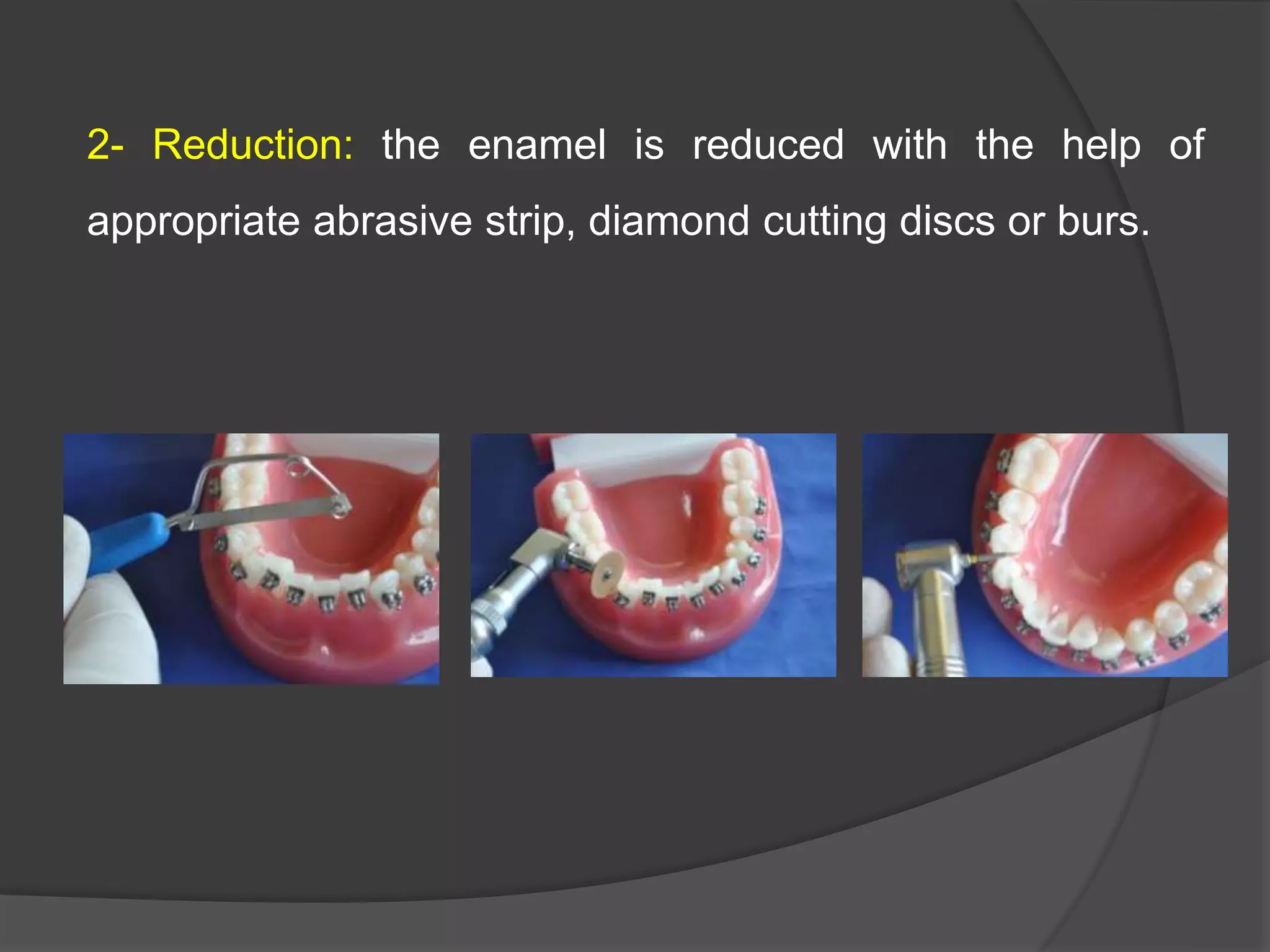 Interproximal Enamel Reduction (stripping) | PPTX