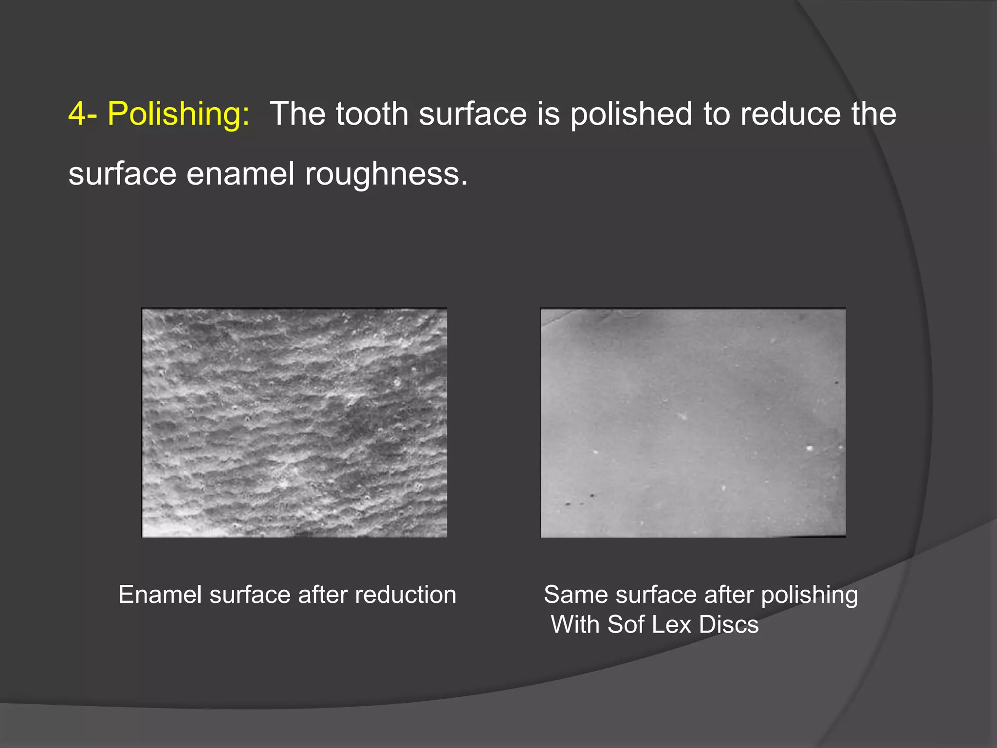 Interproximal Enamel Reduction (stripping) | PPTX