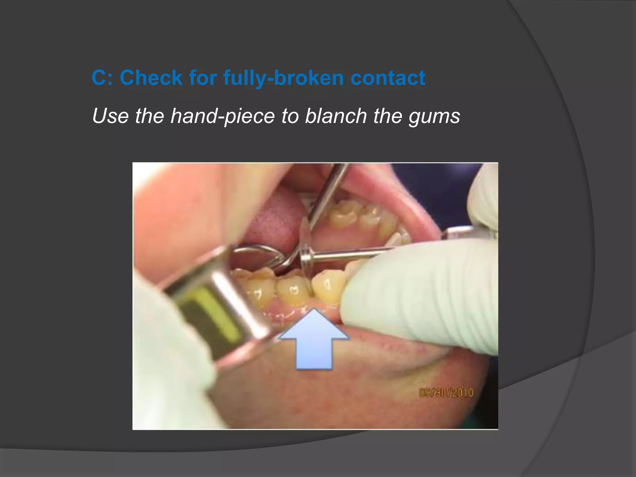 Interproximal Enamel Reduction (stripping) | PPTX