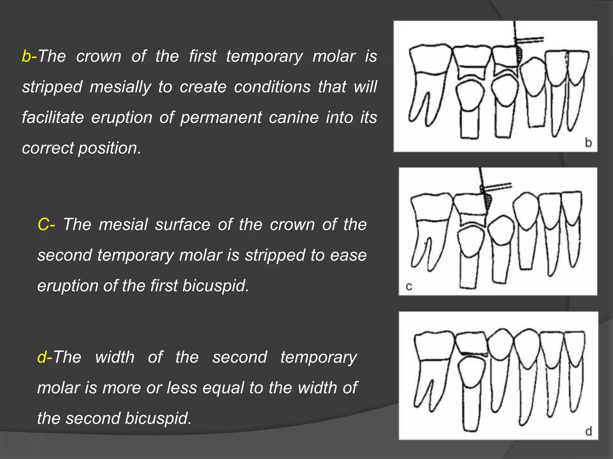 Interproximal Enamel Reduction (stripping) | PPTX