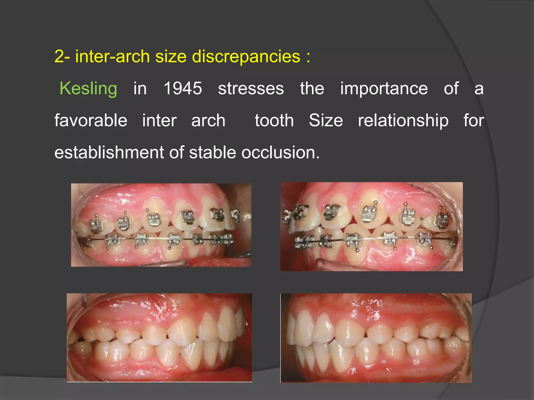 Interproximal Enamel Reduction (stripping) | PPTX