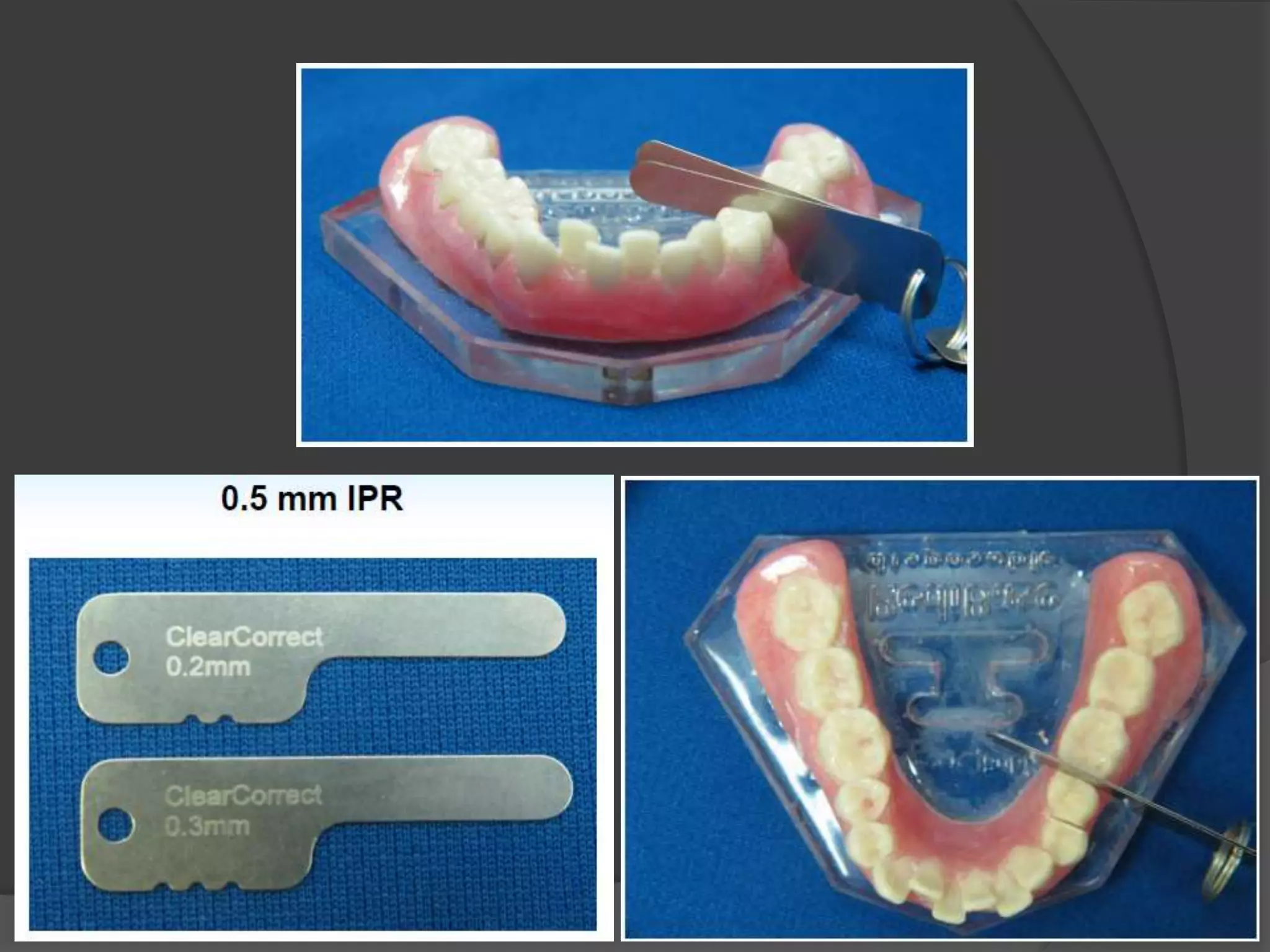 Interproximal Enamel Reduction (stripping) | PPTX