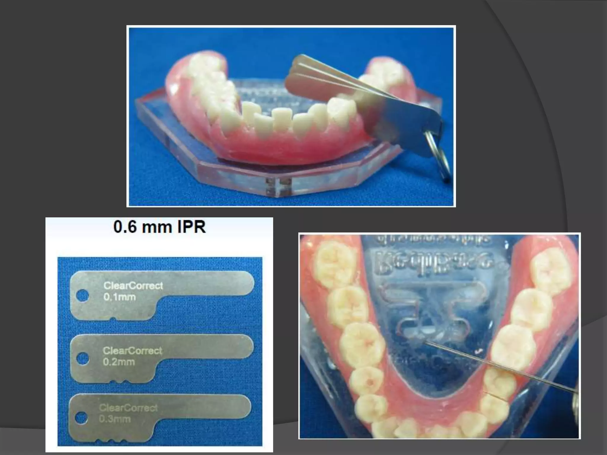 Interproximal Enamel Reduction (stripping) | PPTX