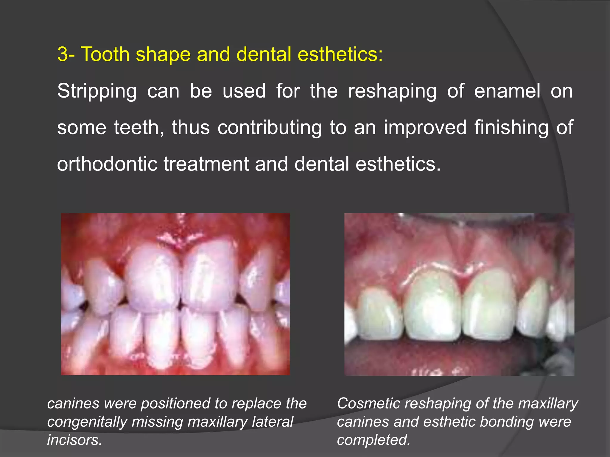 Interproximal Enamel Reduction (stripping) | PPTX