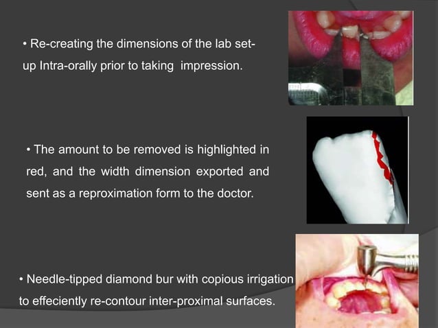 Interproximal Enamel Reduction (stripping) | PPTX | Dental Health ...