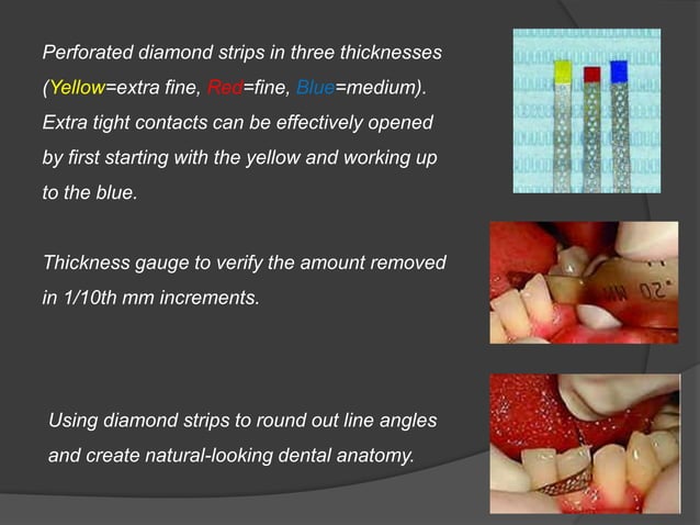 Interproximal Enamel Reduction (stripping) | PPTX | Dental Health ...