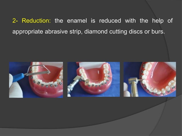 Interproximal Enamel Reduction (stripping) | PPTX | Dental Health ...