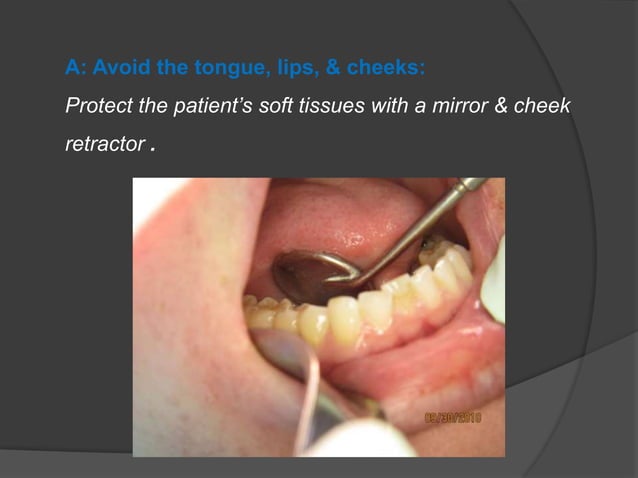 Interproximal Enamel Reduction (stripping) | PPTX | Dental Health ...
