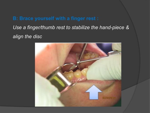 Interproximal Enamel Reduction (stripping) | PPTX | Dental Health ...