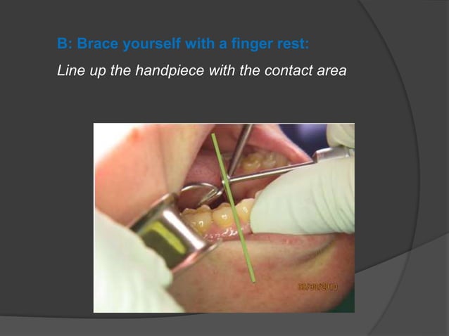 Interproximal Enamel Reduction (stripping) | PPTX | Dental Health ...
