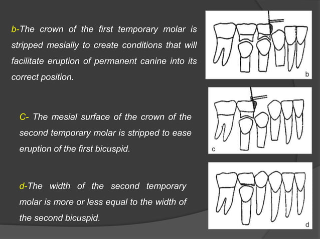 Interproximal Enamel Reduction (stripping) | PPTX | Dental Health ...