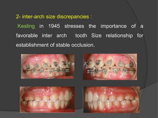 Interproximal Enamel Reduction (stripping) | PPTX | Dental Health ...