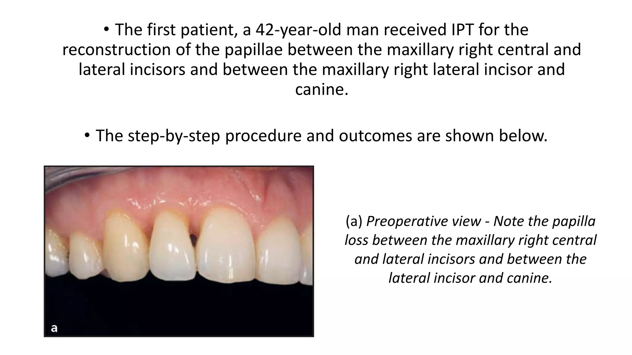 Interproximal tunneling with a customized connective tissue graft a ...