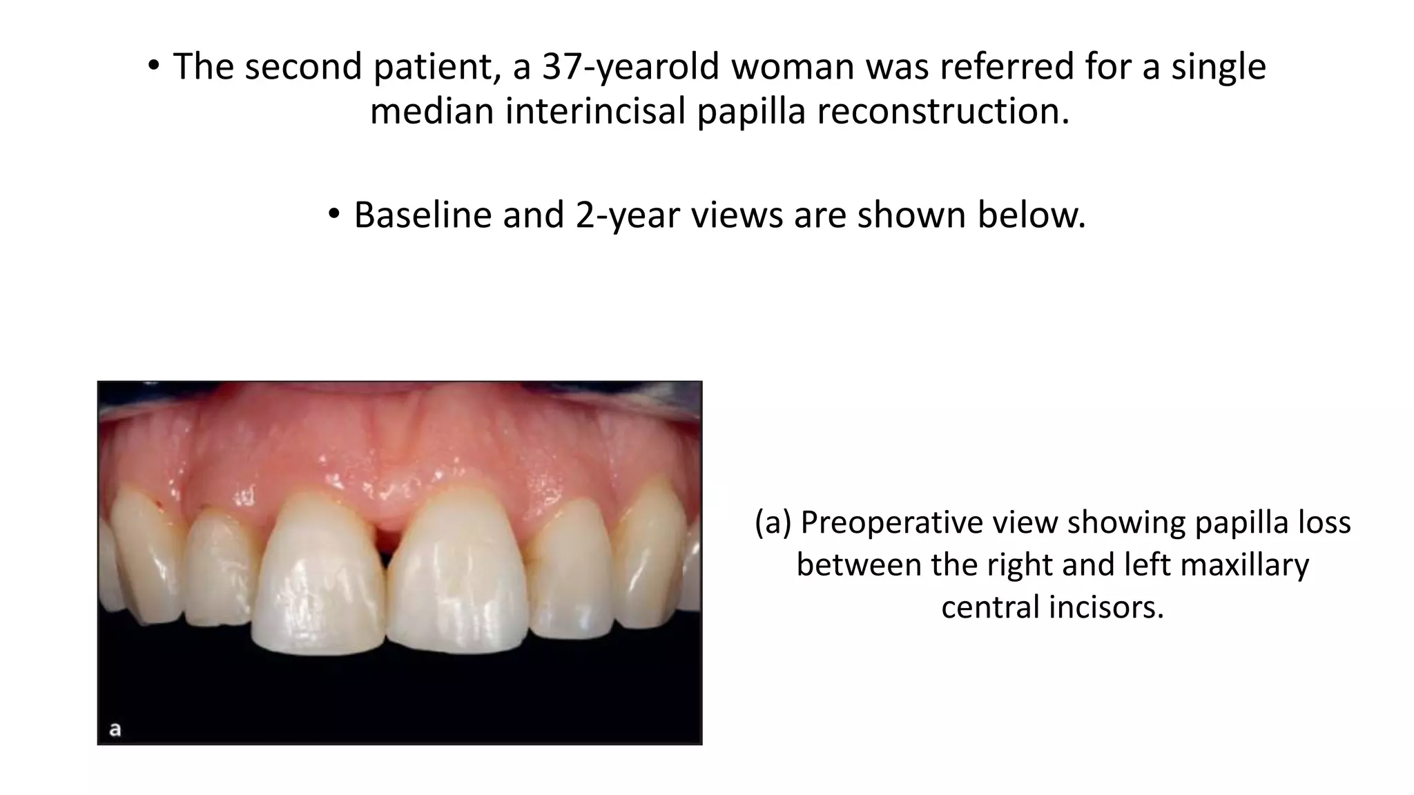 Interproximal tunneling with a customized connective tissue graft a ...