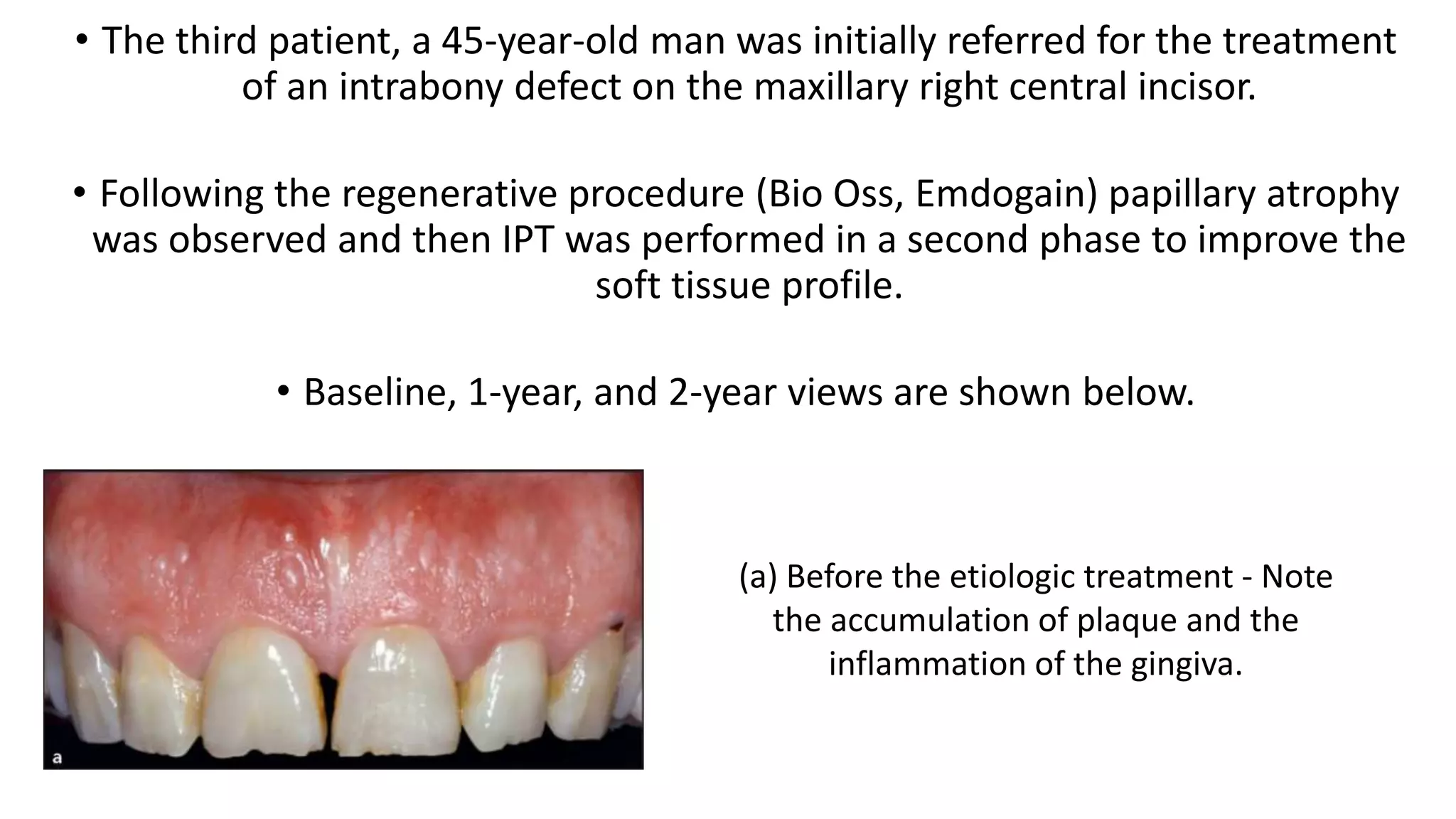 Interproximal tunneling with a customized connective tissue graft a ...