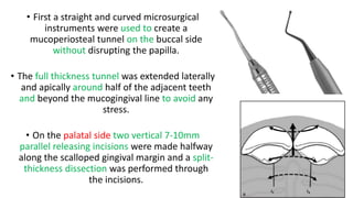 Interproximal tunneling with a customized connective tissue graft a ...
