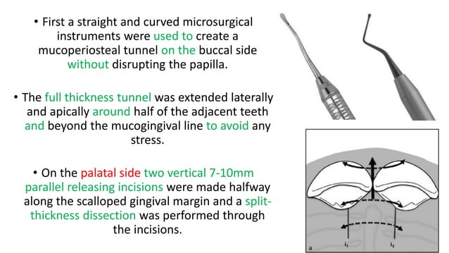 Interproximal tunneling with a customized connective tissue graft a ...