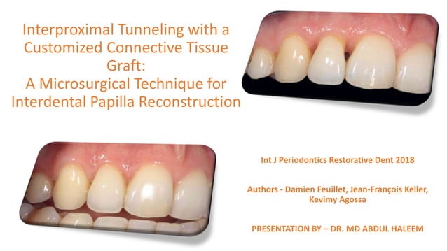 Interproximal tunneling with a customized connective tissue graft a ...