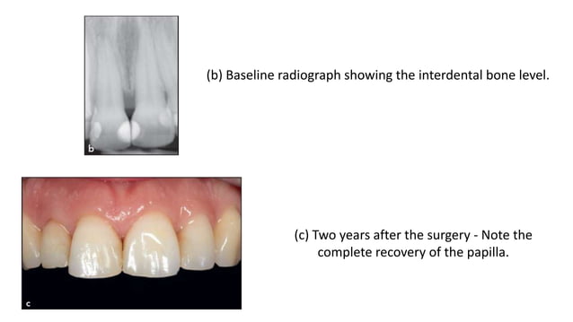 Interproximal tunneling with a customized connective tissue graft a ...