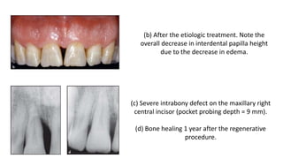 Interproximal tunneling with a customized connective tissue graft a ...