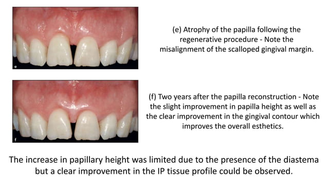 Interproximal tunneling with a customized connective tissue graft a ...