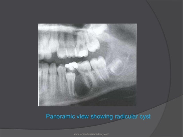 Inter Radicular Radiolucencies Dental Courses