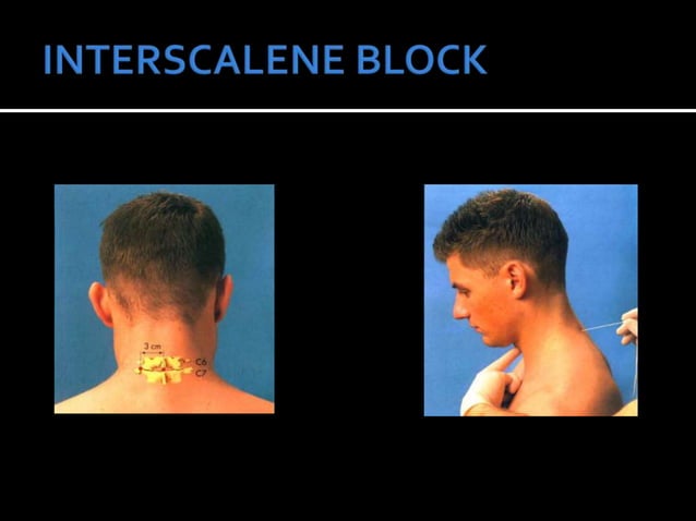 Interscalene & supraclavicular nerve blocks | PPTX