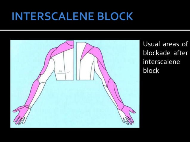 Interscalene & supraclavicular nerve blocks | PPT