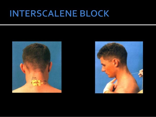 Interscalene & supraclavicular nerve blocks