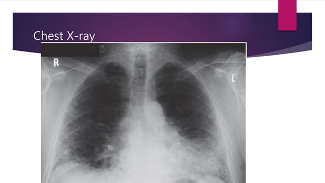 interstial lung deases.pptx