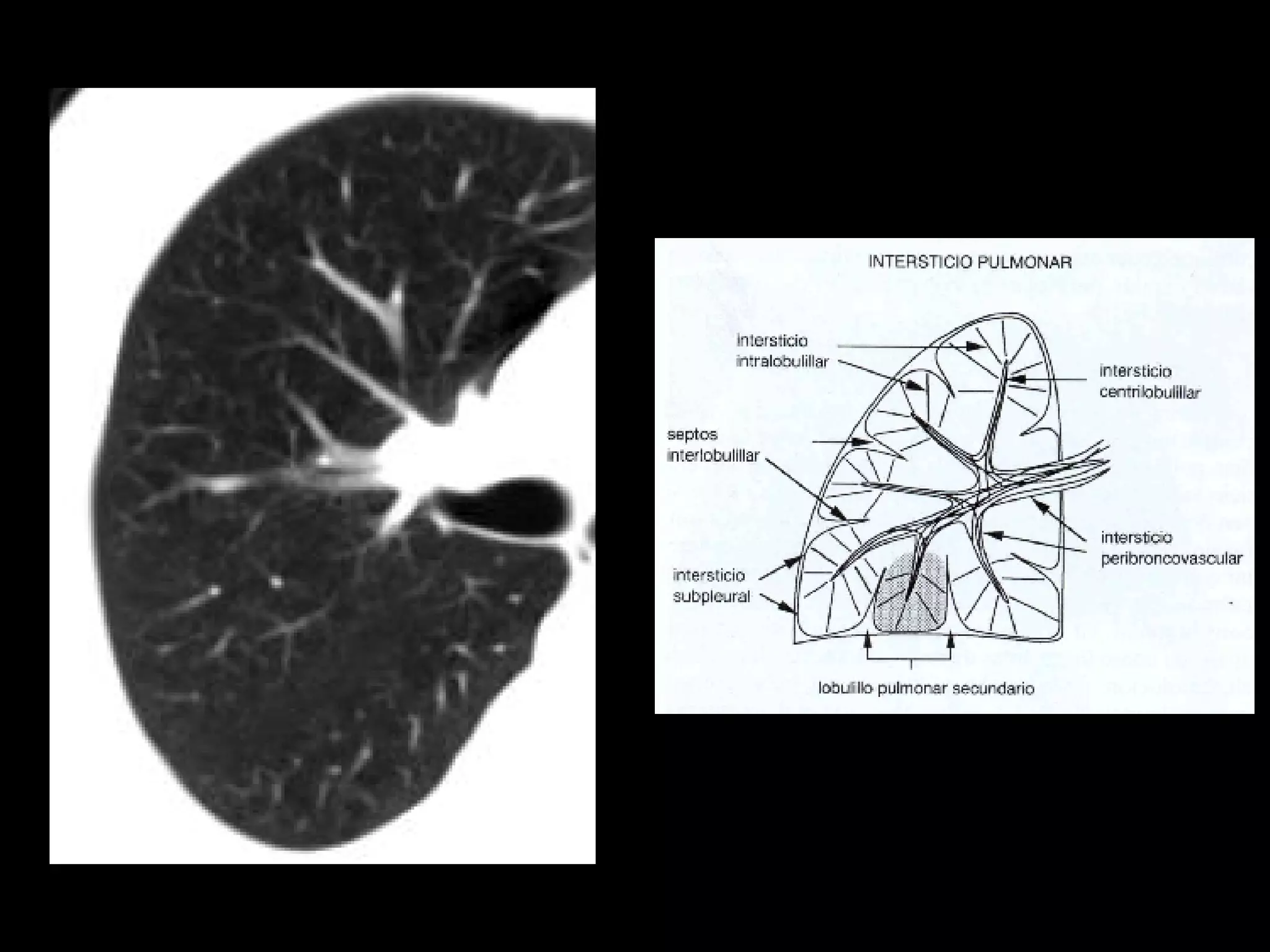 Intersticio pulmonar | PPT