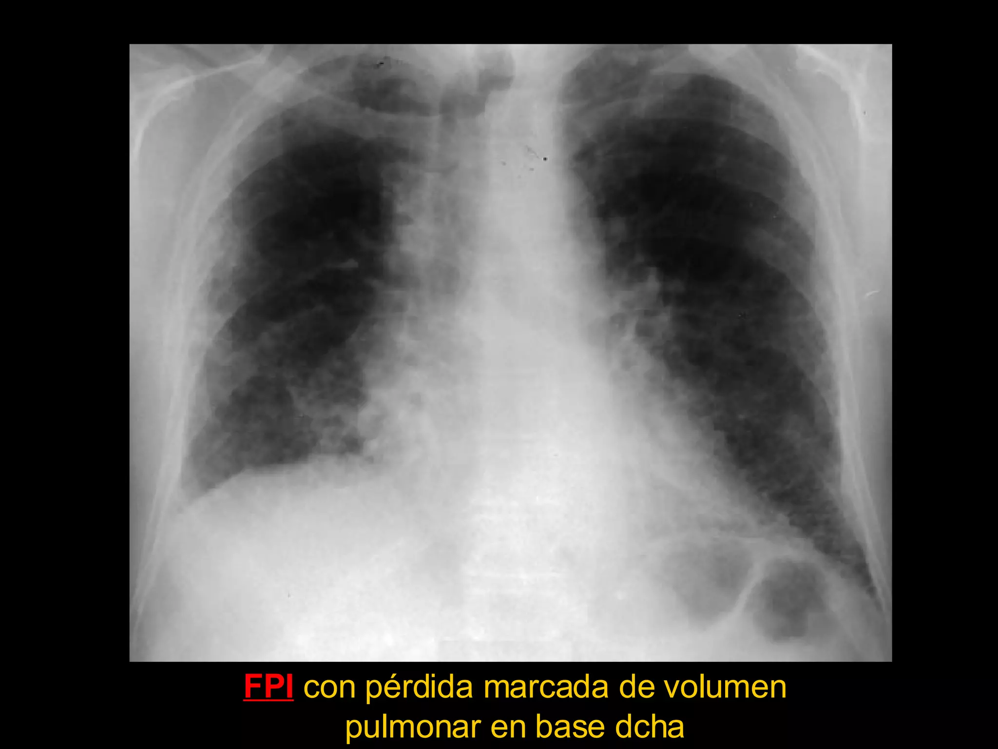 Intersticio pulmonar | PPT