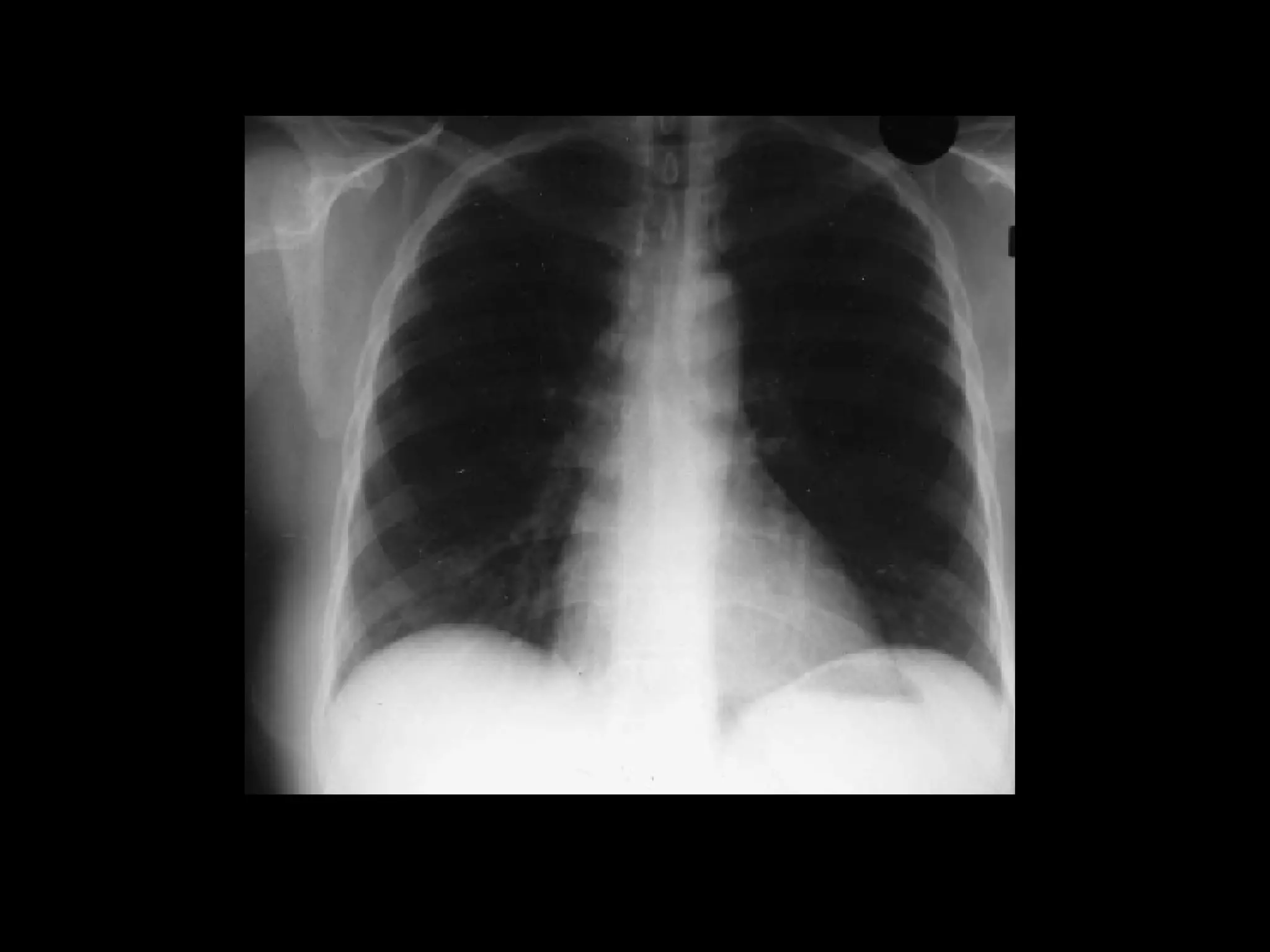Intersticio pulmonar | PPT