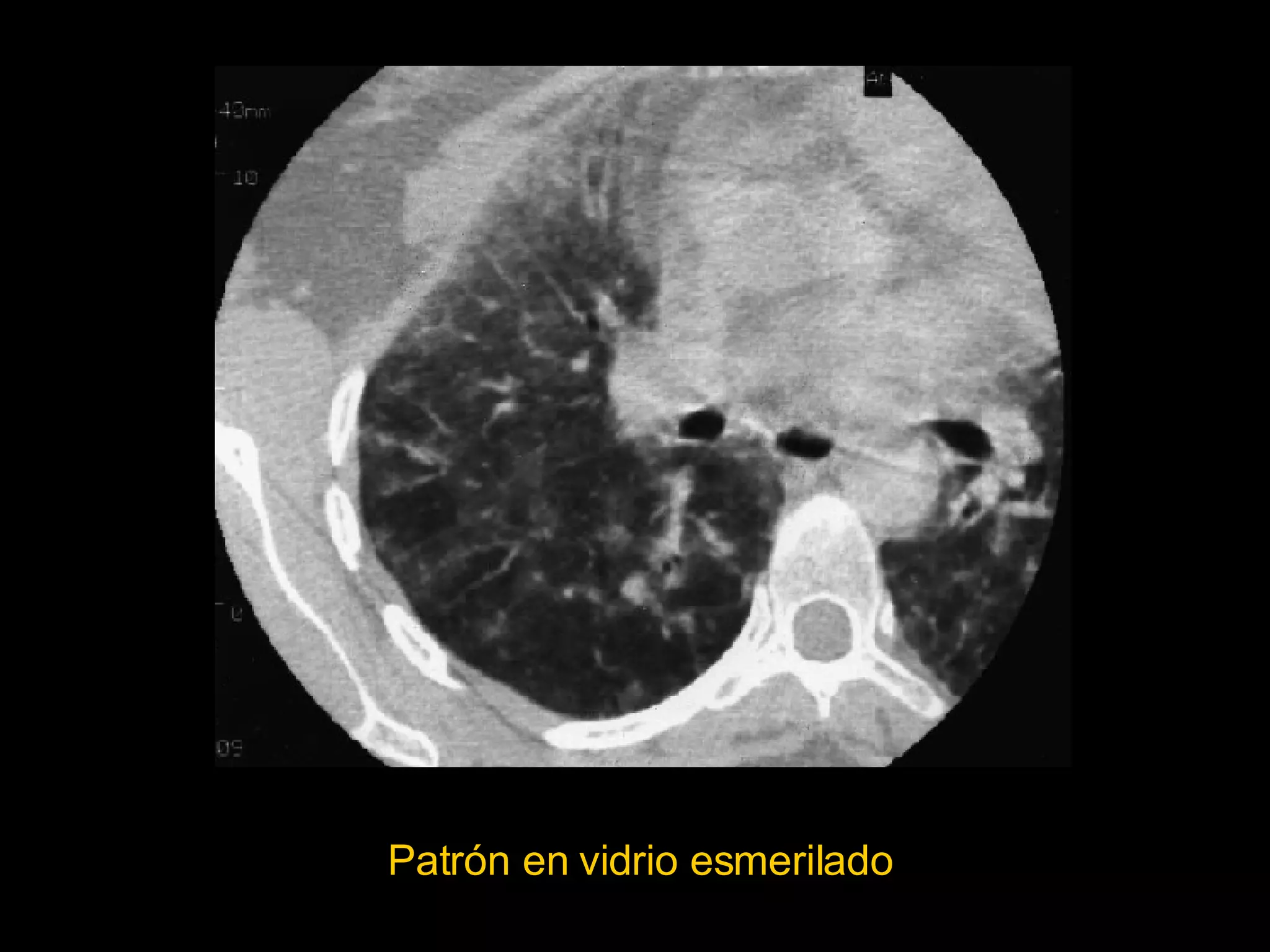 Intersticio pulmonar | PPT
