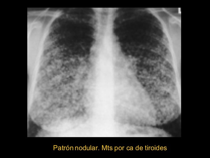 Tac Torax Patron Nodular Casos PEDiatricos On Line [Web PEDiatrica]