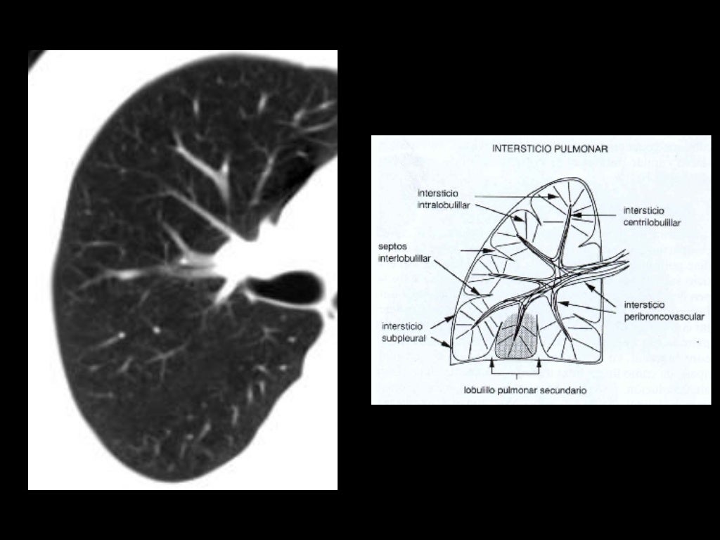 Intersticio pulmonar