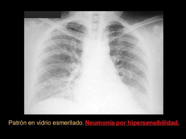 Intersticio pulmonar
