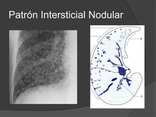 Intersticio pulmonar | PPTX