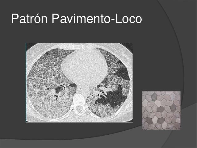 Intersticio pulmonar