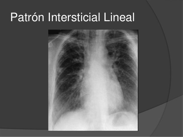 Intersticio pulmonar