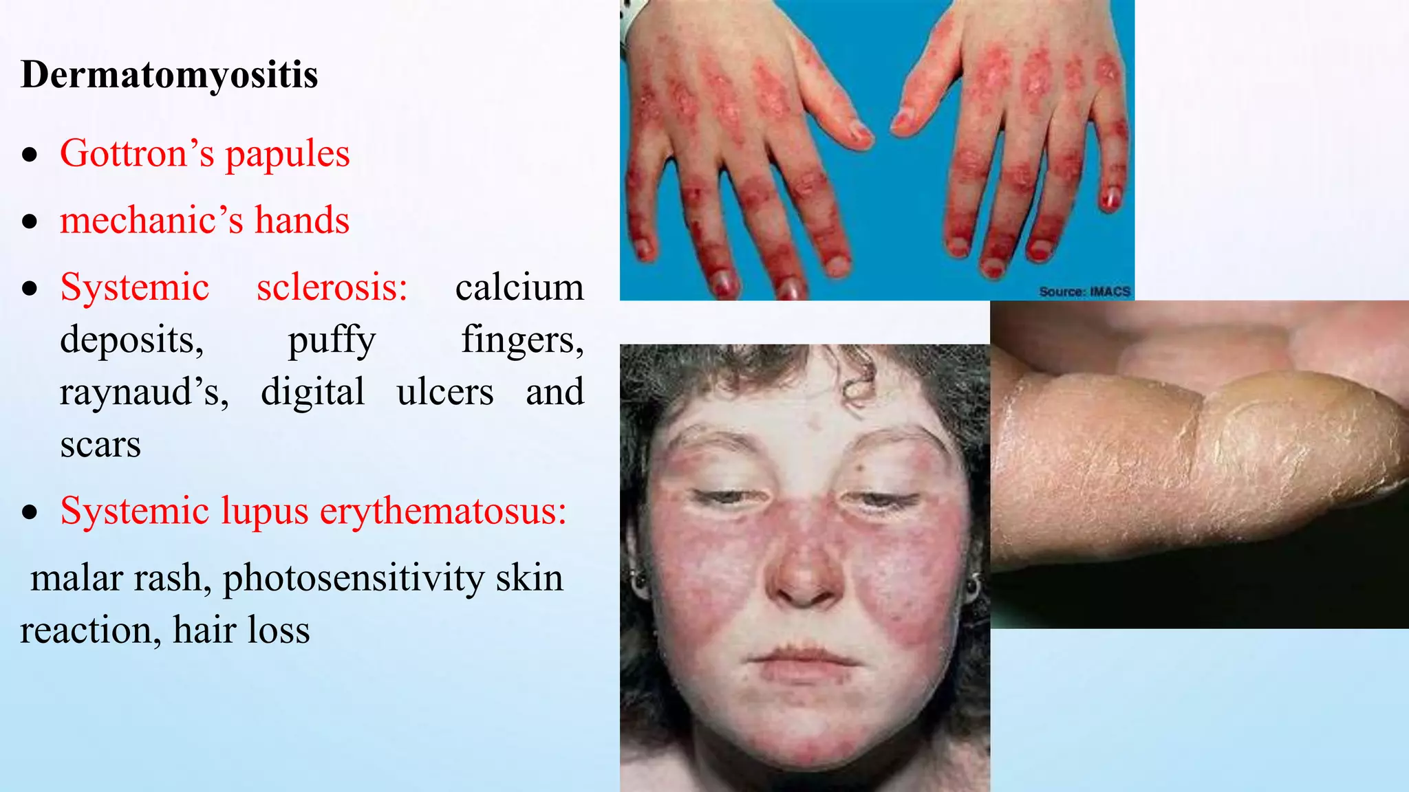 Interstitial lung disease (ILD) ppt slideshare | PPTX