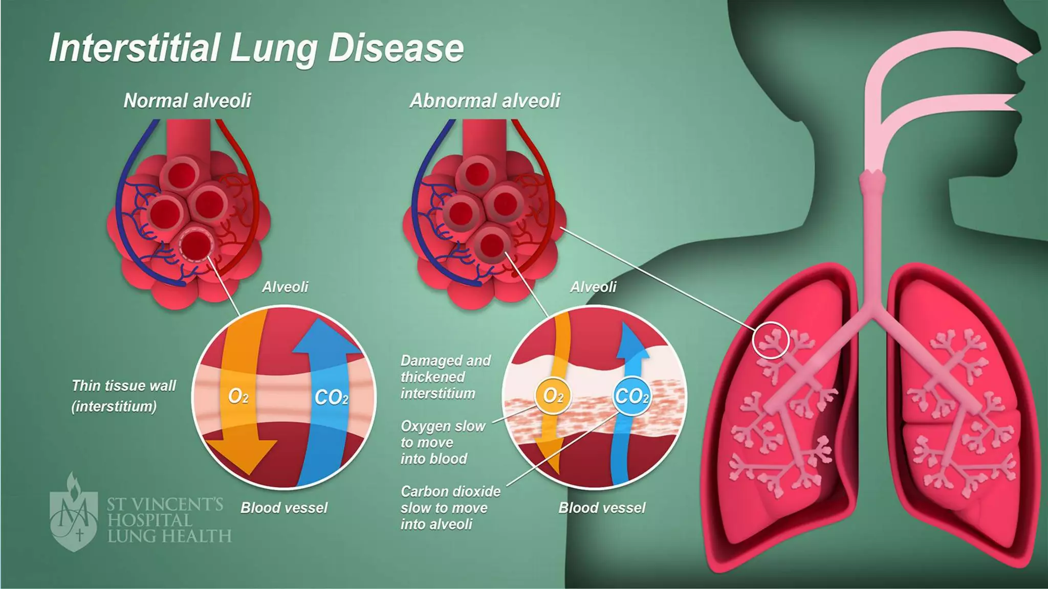 Interstitial lung disease (ILD) ppt slideshare | PPTX