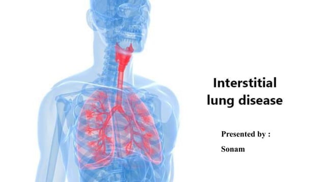 Interstitial lung disease (ILD) ppt slideshare | PPTX | Lung and Respiratory Health | Diseases ...