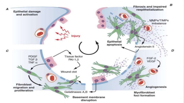 Interstitial lung disease (ILD) ppt slideshare | PPTX | Lung and ...