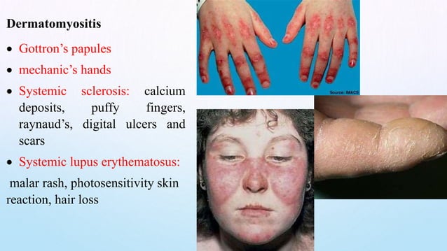 Interstitial lung disease (ILD) ppt slideshare | PPTX | Lung and ...