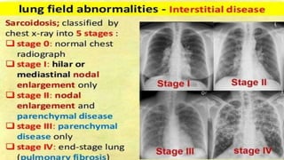Interstitial lung disease (ILD) ppt slideshare | PPTX