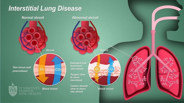 Interstitial lung disease (ILD) ppt slideshare | PPTX | Lung and Respiratory Health | Diseases ...